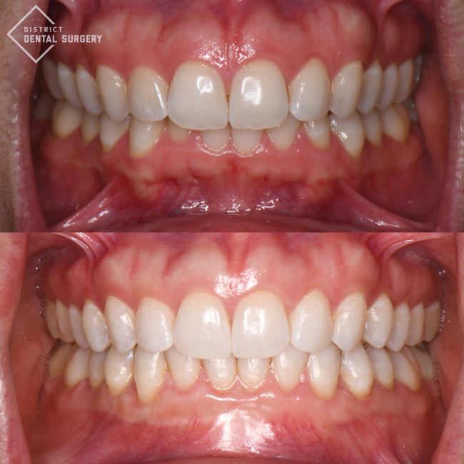 What is SFOT? Surgically Facilitated Orthodontic Therapy Explained ...