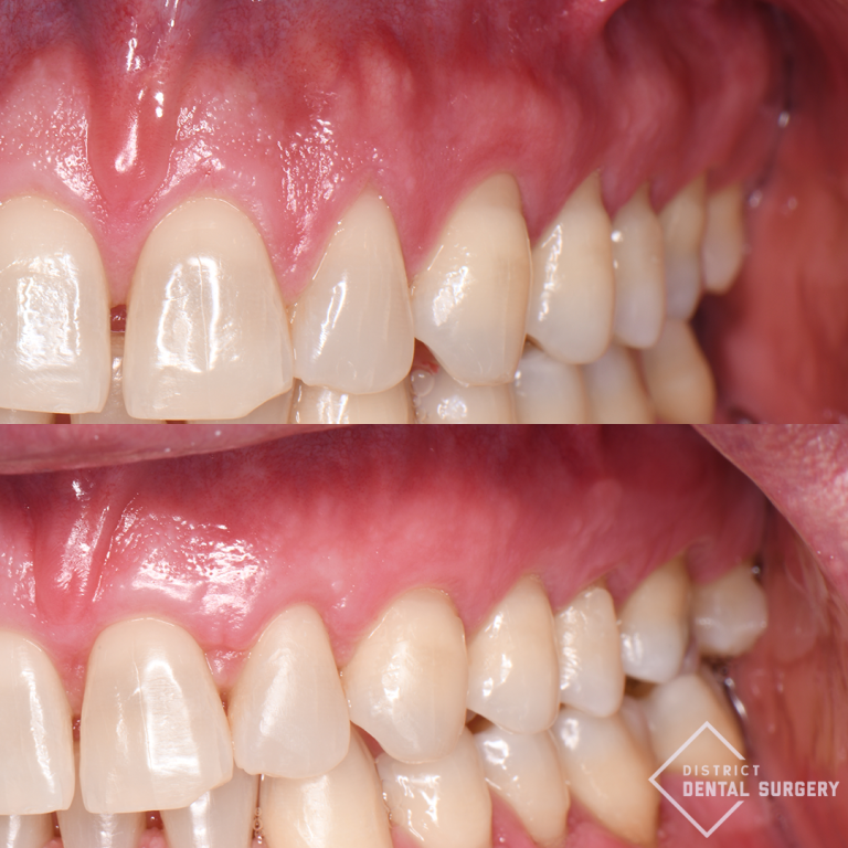 What is SFOT? Surgically Facilitated Orthodontic Therapy Explained ...