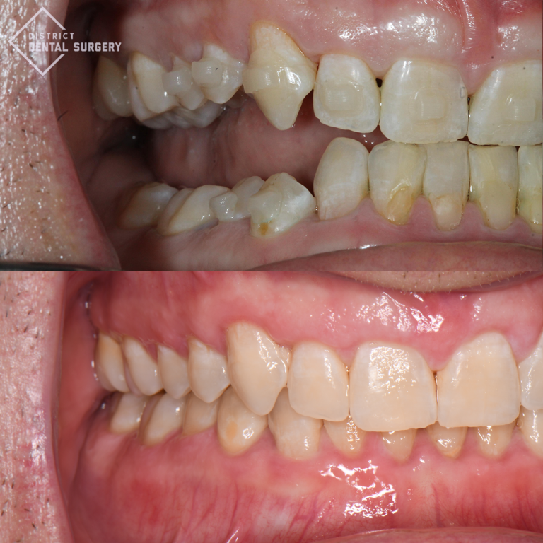 What is SFOT? Surgically Facilitated Orthodontic Therapy Explained ...