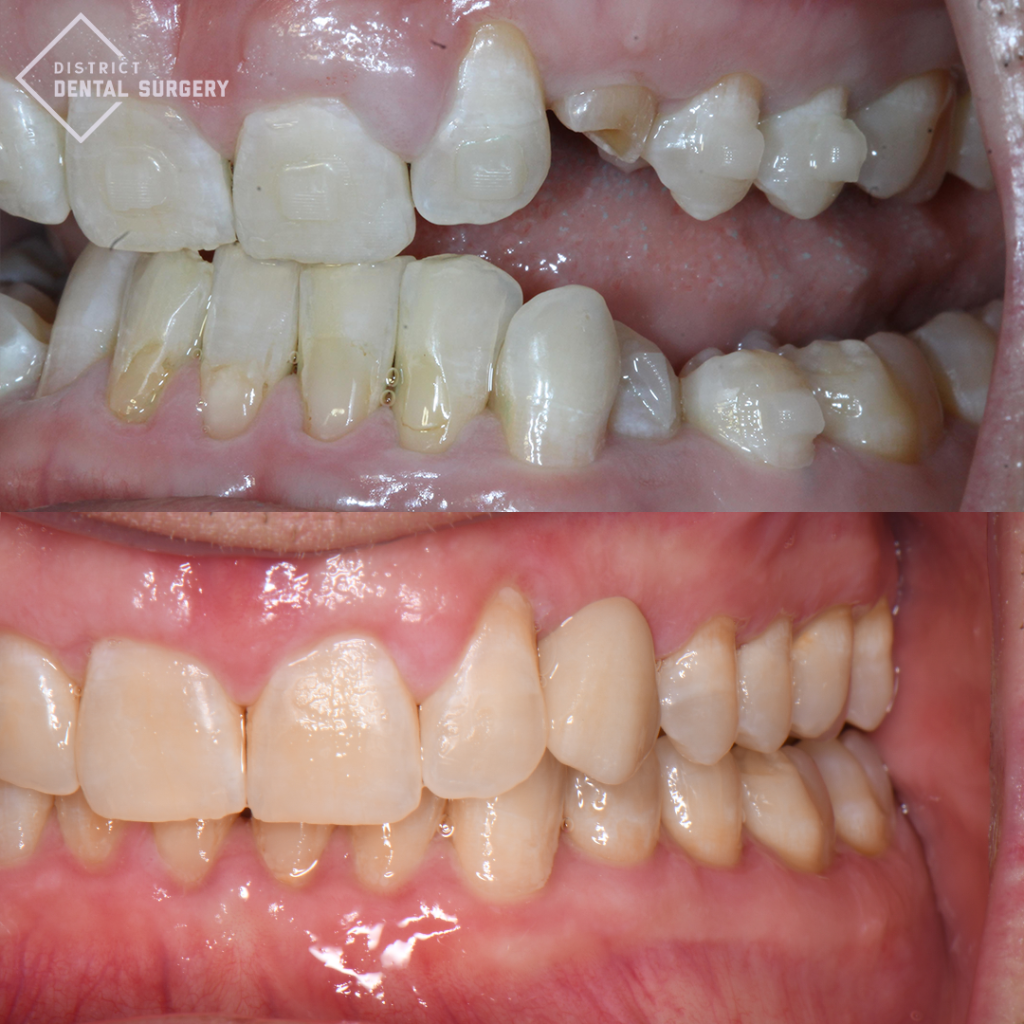 What is SFOT? Surgically Facilitated Orthodontic Therapy Explained ...