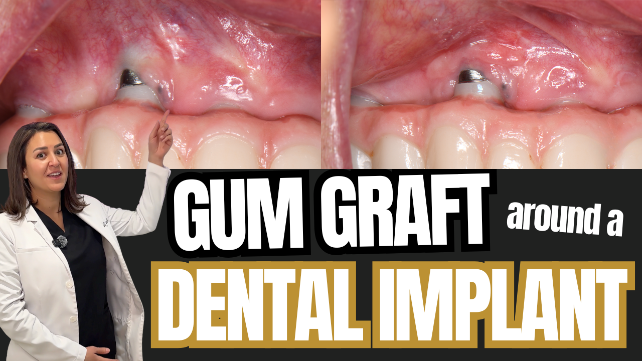Gum Graft Around a Dental Implant - District Dental Surgery